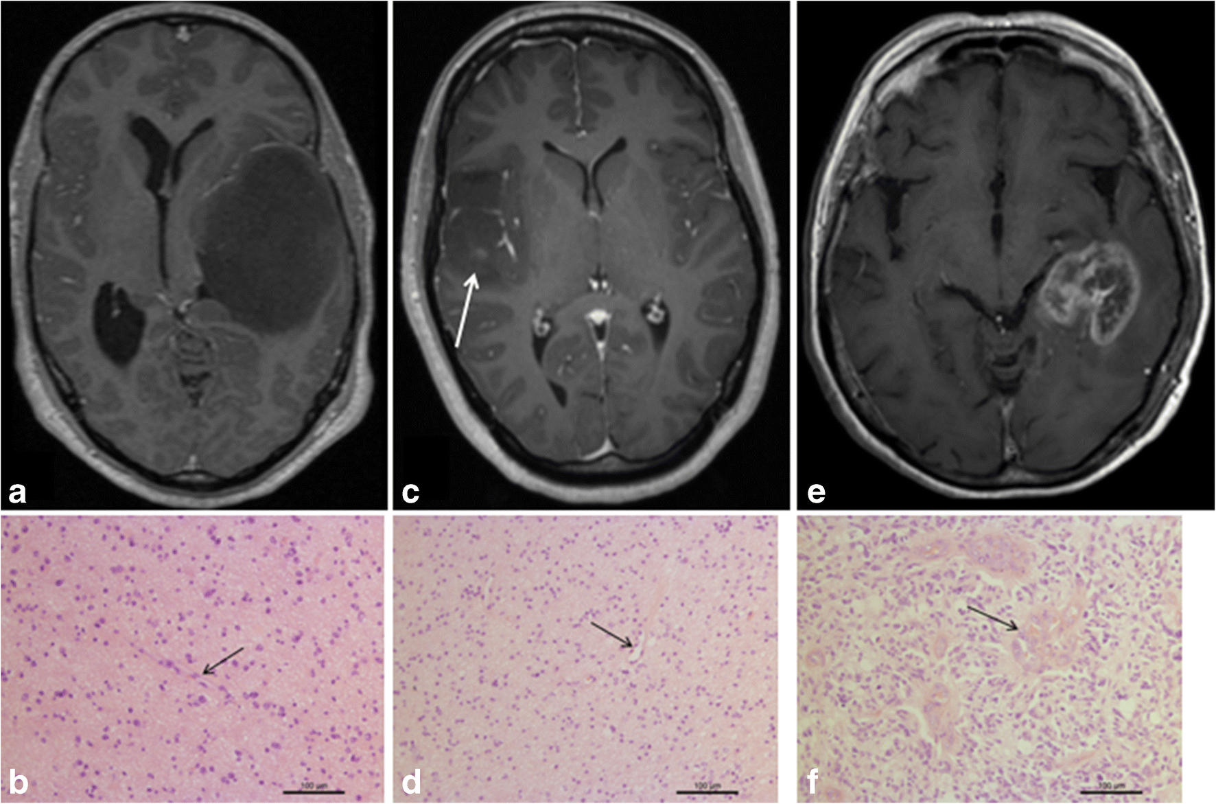 Gadolinium retention in gliomas and adjacent normal brain tissue ...