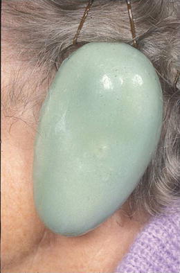 Auricular pressure-relieving cushions for treatment of ...