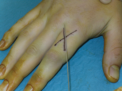 A simple method to optimise Kirschner wire fixation of hand fractures ...