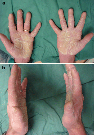 Congenital tylosis and the role of the plastic and reconstructive ...