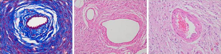 A safe method for excision of a giant neurofibroma on both buttocks ...