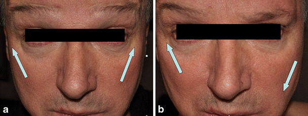 Is the malaris muscle the anti-aging missing link of the midface ...