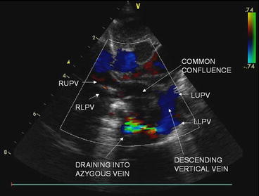 Supracardiac Total Anomalous Pulmonary Venous Connection with A ...