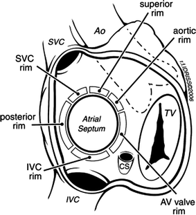 Recent Changes in Instructions for Use for the Amplatzer Atrial Septal ...