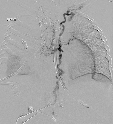 The Lymphatic Circulation in Adaptations to the Fontan Circulation ...