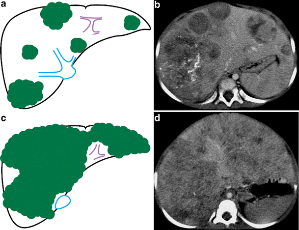2005 PRETEXT: a revised staging system for primary malignant liver ...