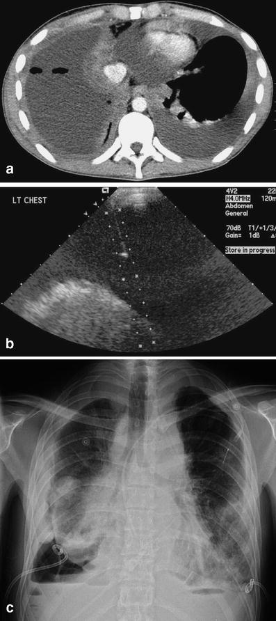 Pleurodesis for effusions in pediatric oncology patients at end of life ...