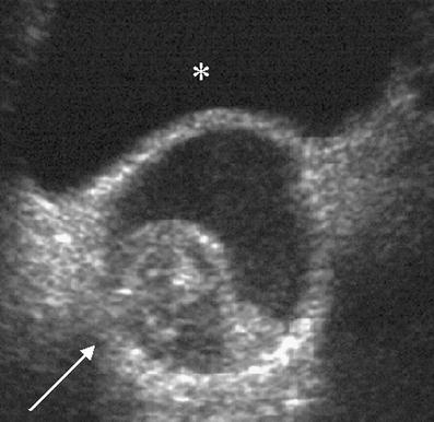 Congenital anomalies of the male urethra | SpringerLink