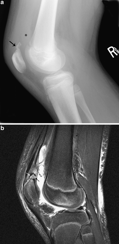Sleeve fracture at the superior pole of the patella | SpringerLink