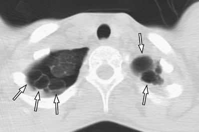 CT findings for blebs and bullae in children with spontaneous ...