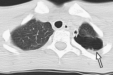 CT findings for blebs and bullae in children with spontaneous ...