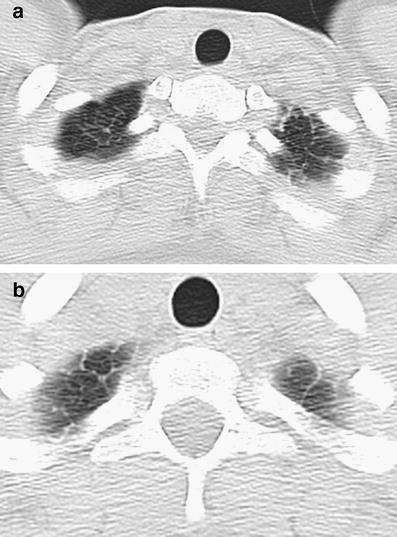 CT findings for blebs and bullae in children with spontaneous ...