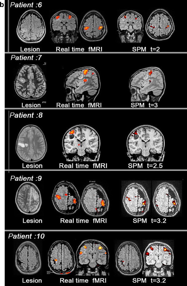 Real-time functional MR imaging (fMRI) for presurgical evaluation of ...