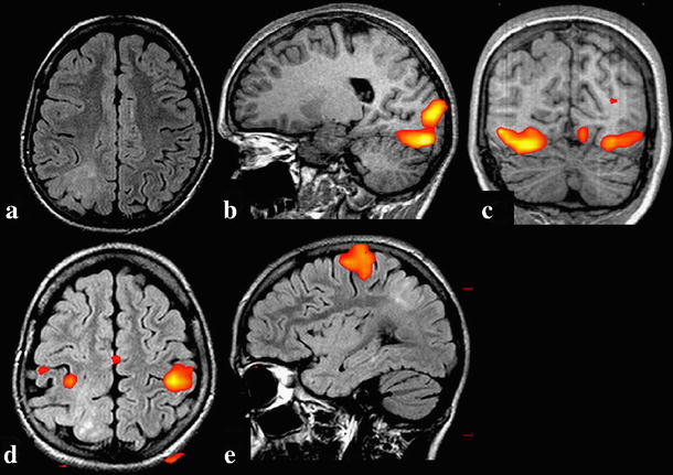 Real-time functional MR imaging (fMRI) for presurgical evaluation of ...