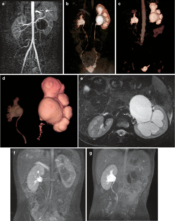 Evaluation of UPJ obstruction before and after pyeloplasty using MR ...