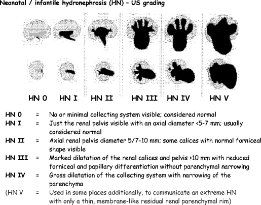 Imaging recommendations in paediatric uroradiology: minutes of the ESPR ...