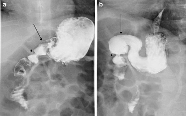 Gastric volvulus in children: the twists and turns of an unusual entity ...
