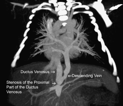 Infracardiac total anomalous pulmonary venous return (TAPVR) | SpringerLink