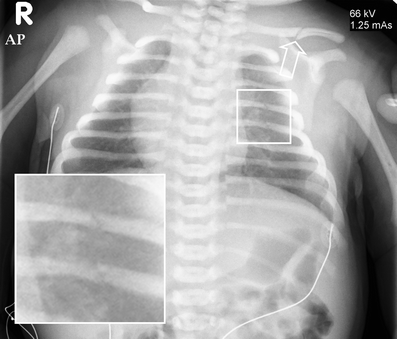 Birth-related mid-posterior rib fractures in neonates: a report of ...