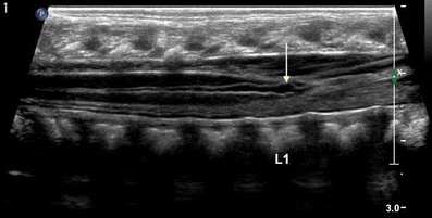 Congenital persistent terminal ventricle and filar cyst | SpringerLink