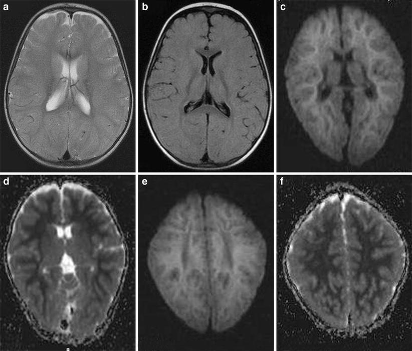 The DWI ‘reversal sign’ of white matter hypoxic ischaemic injury in ...