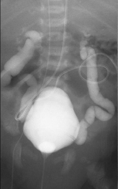 Congenital megalourethra | SpringerLink