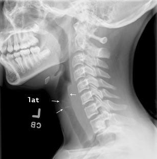 Membranous croup (exudative tracheitis or membranous ...