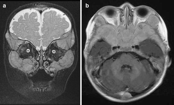 Periorbital ecchymosis (‘raccoon eyes’) as the presenting feature of ...