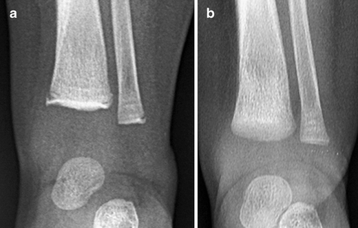 How to explore and report children with suspected non-accidental trauma ...