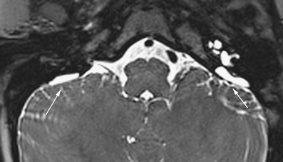 Large endolymphatic sac anomaly | SpringerLink