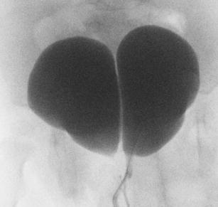 Duplicated bladder | SpringerLink