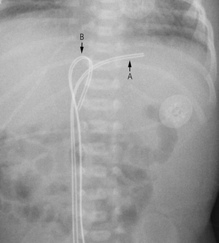 Umbilical vein catheterization—appropriate and inappropriate placement ...