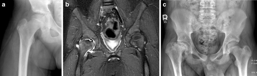 Unexpected MRI findings in clinically suspected Legg-Calvé-Perthes ...