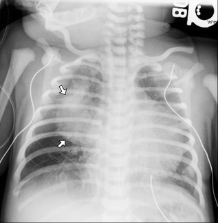 Newborn with tetralogy of Fallot and absent pulmonary valve | SpringerLink
