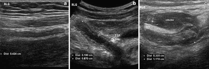 Revised ultrasound criteria for appendicitis in children improve ...