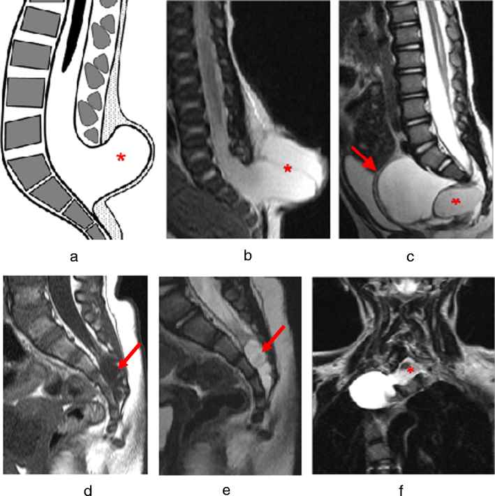 MRI of closed spinal dysraphisms | SpringerLink