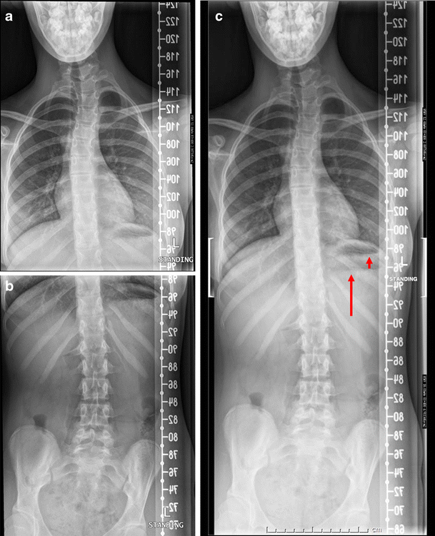 Diagnostic errors from digital stitching of scoliosis images – the ...