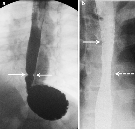 Fluoroscopic findings in pediatric eosinophilic esophagitis | SpringerLink