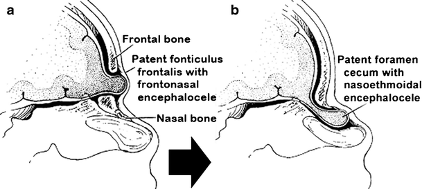 Congenital midline nasofrontal masses | SpringerLink