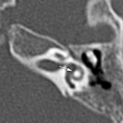 Inner ear anomalies seen on CT images in people with Down syndrome ...