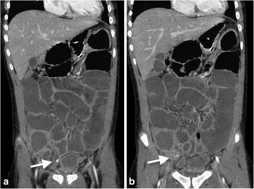 Utility of CT in the diagnosis and management of small-bowel ...