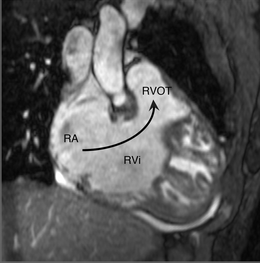 Right ventricular apical sequestration: demonstration of a rare variant ...