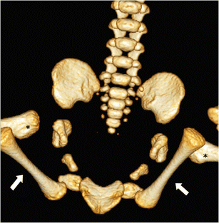 In utero and postnatal imaging findings of parasitic conjoined twins ...