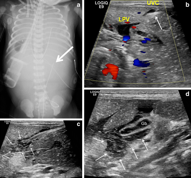 Umbilical venous catheter malposition and errors in interpretation in ...