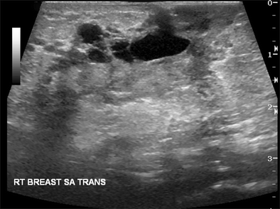 Ultrasound of pediatric breast masses: what to do with lumps and bumps ...