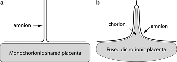 Guidelines for scanning twins and triplets with US and MRI | SpringerLink