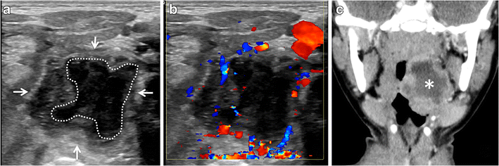 Tonsil ultrasound: technical approach and spectrum of pediatric ...