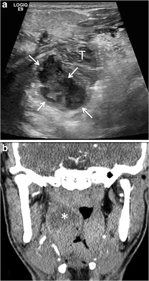 Tonsil ultrasound: technical approach and spectrum of pediatric ...