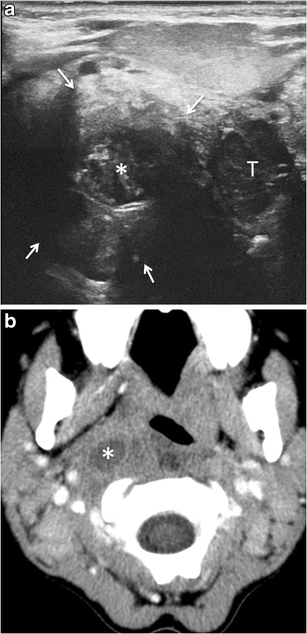 Tonsil ultrasound: technical approach and spectrum of pediatric ...