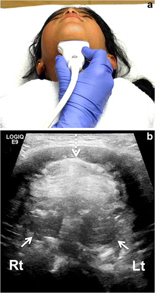 Tonsil ultrasound: technical approach and spectrum of pediatric ...